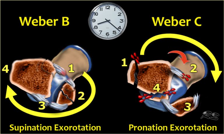 The Radiology Assistant : Ankle fractures - Weber and Lauge-Hansen ...