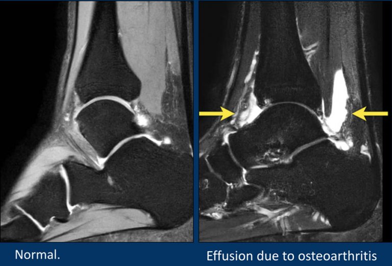 The Radiology Assistant : MRI examination of the ankle
