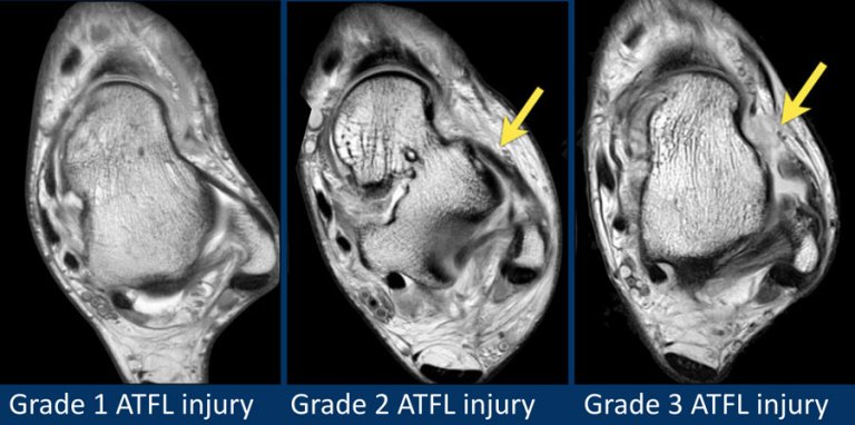 The Radiology Assistant : MRI examination of the ankle