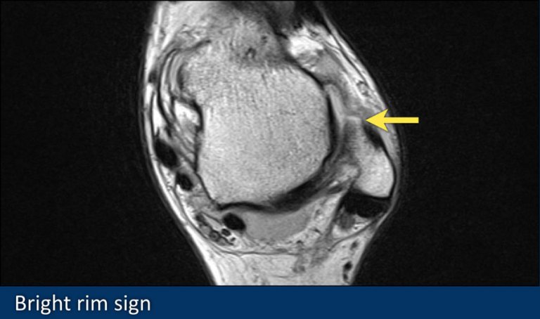The Radiology Assistant : MRI examination of the ankle