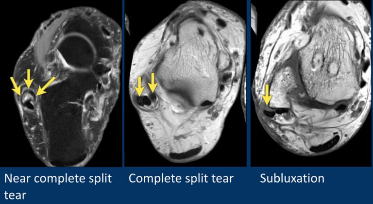 The Radiology Assistant : MRI examination of the ankle