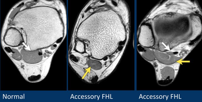 The Radiology Assistant : MRI examination of the ankle