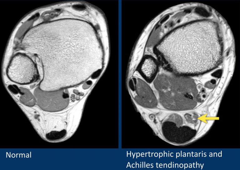 The Radiology Assistant : MRI examination of the ankle