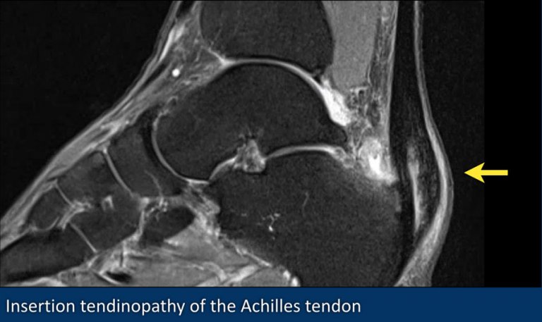 The Radiology Assistant : MRI examination of the ankle