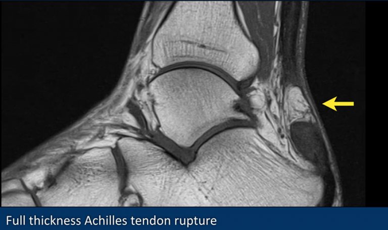 The Radiology Assistant : MRI examination of the ankle