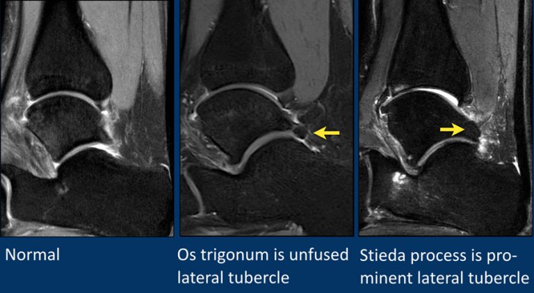The Radiology Assistant : MRI examination of the ankle