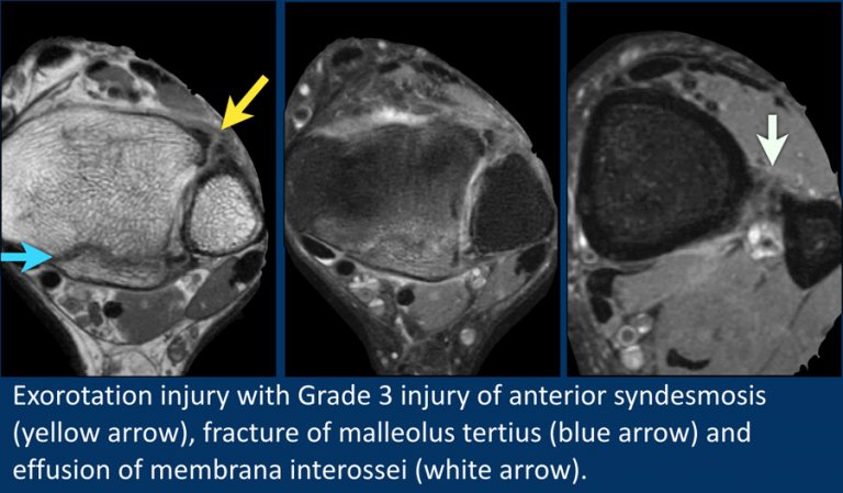 The Radiology Assistant : MRI examination of the ankle