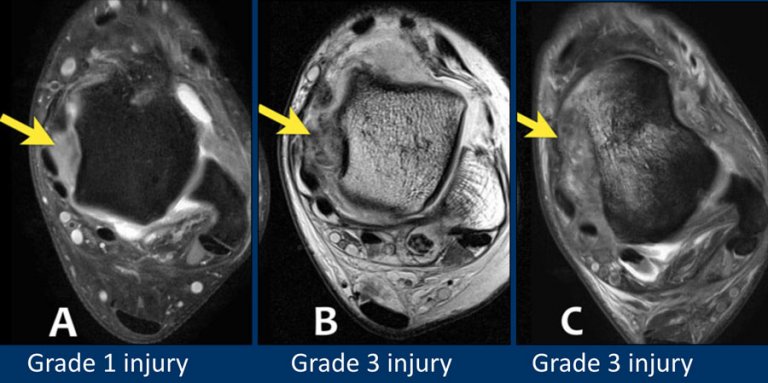 The Radiology Assistant : MRI examination of the ankle