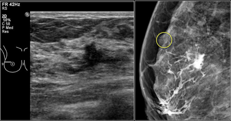 The Radiology Assistant : Bi-RADS for Mammography and Ultrasound 2013