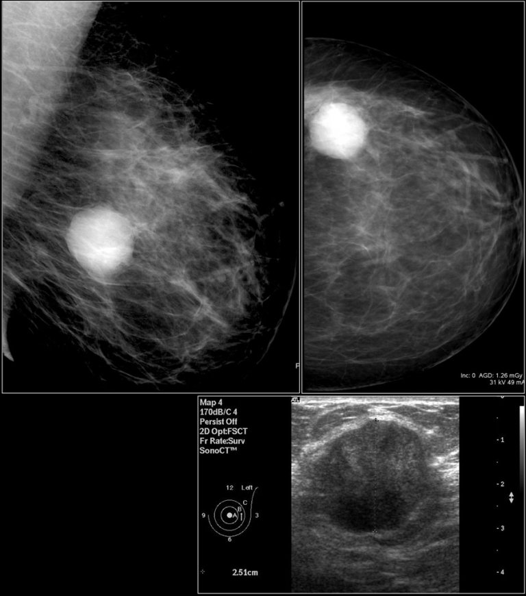 The Radiology Assistant : Bi-RADS for Mammography and Ultrasound 2013