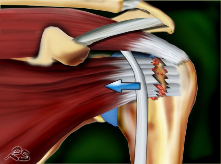 The Radiology Assistant : Shoulder - Rotator cuff injury