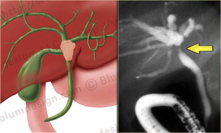 The Radiology Assistant : Biliary duct pathology