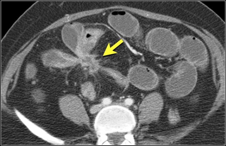 The Radiology Assistant : CT-pattern of Bowel wall thickening