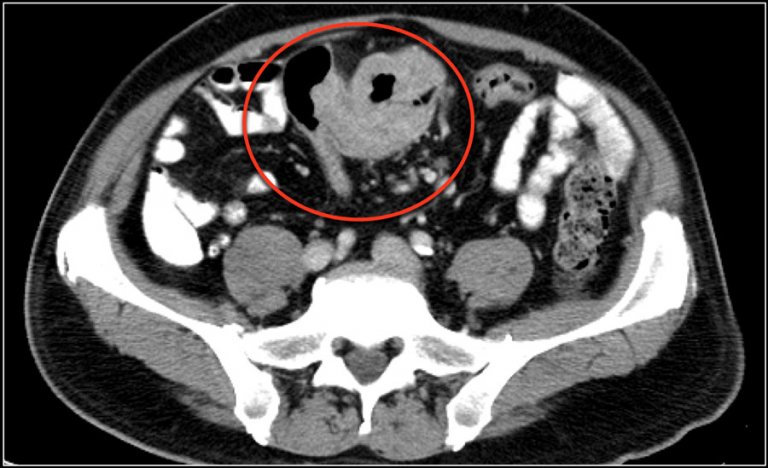 The Radiology Assistant : CT-pattern of Bowel wall thickening