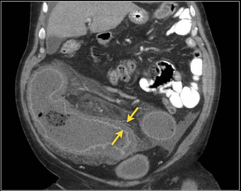 The Radiology Assistant : CT-pattern of Bowel wall thickening