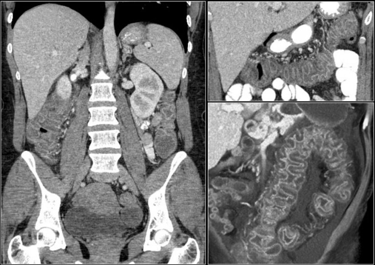The Radiology Assistant : CT-pattern of Bowel wall thickening