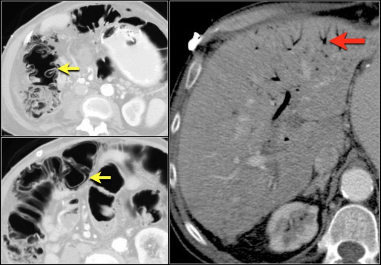 The Radiology Assistant : CT-pattern of Bowel wall thickening