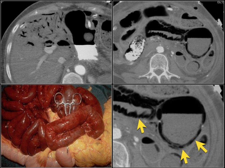 The Radiology Assistant : CT-pattern of Bowel wall thickening