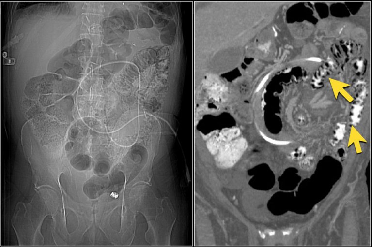 The Radiology Assistant : CT-pattern of Bowel wall thickening