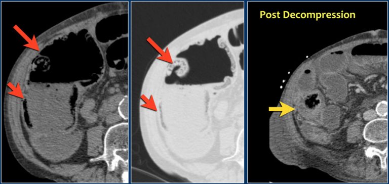 The Radiology Assistant : CT-pattern of Bowel wall thickening