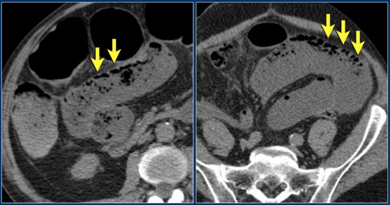 The Radiology Assistant : CT-pattern of Bowel wall thickening