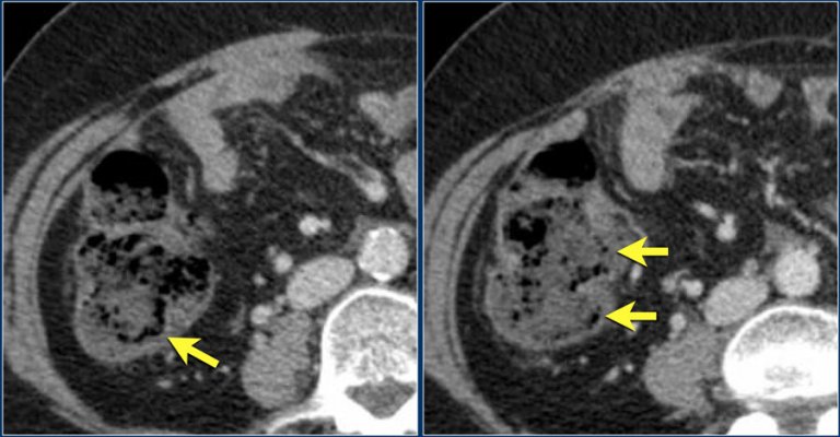 The Radiology Assistant : CT-pattern of Bowel wall thickening