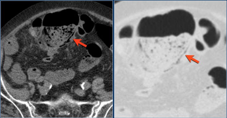 The Radiology Assistant : CT-pattern of Bowel wall thickening