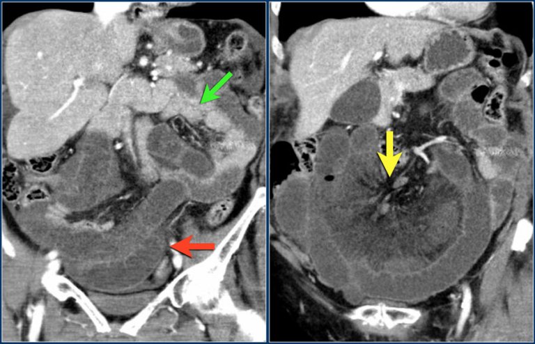 The Radiology Assistant : CT-pattern of Bowel wall thickening