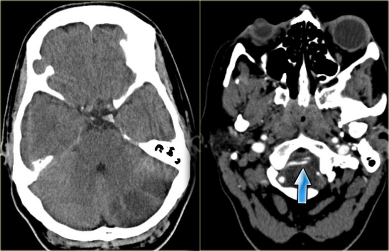 The Radiology Assistant : Vascular territories of the Brain