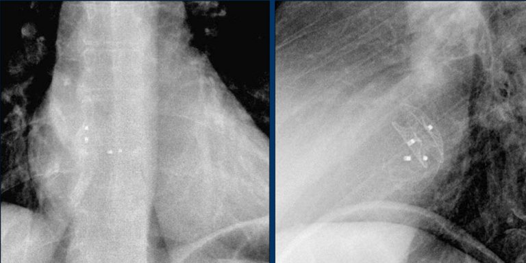 The Radiology Assistant : Cardiovascular devices