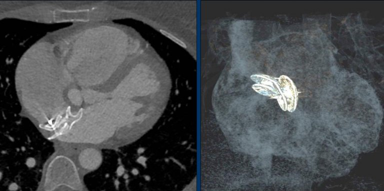 The Radiology Assistant : Cardiovascular devices