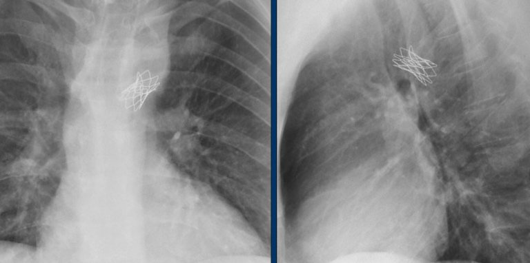 The Radiology Assistant : Cardiovascular devices