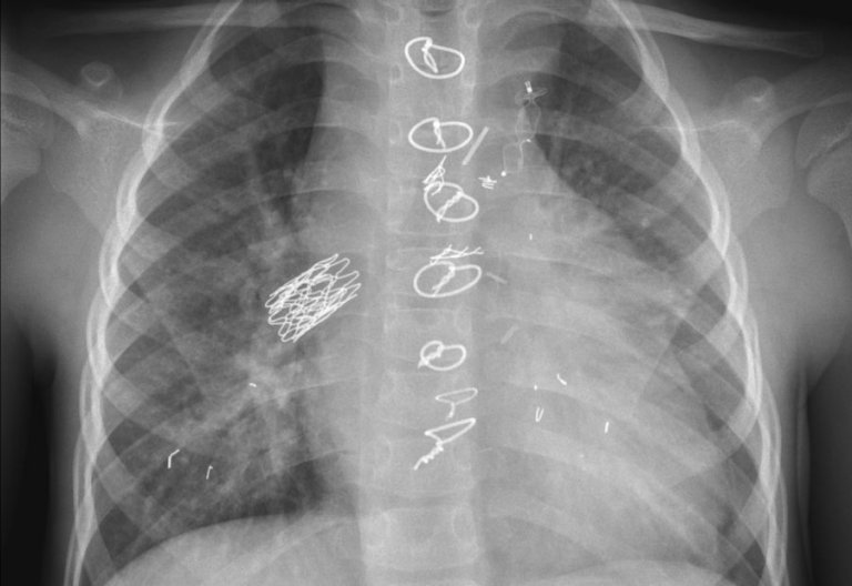 The Radiology Assistant : Cardiovascular devices