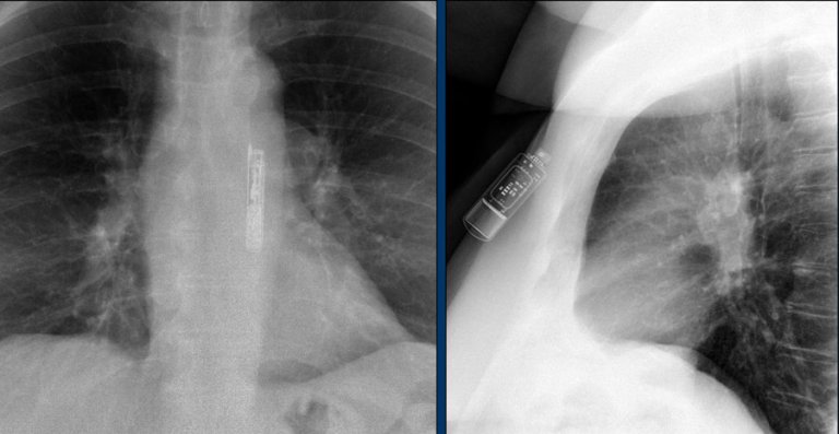 The Radiology Assistant : Cardiovascular devices