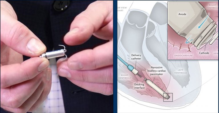 The Radiology Assistant : Cardiovascular devices