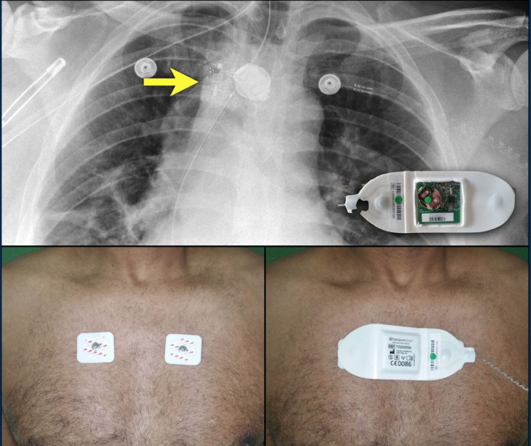 The Radiology Assistant : Cardiovascular devices