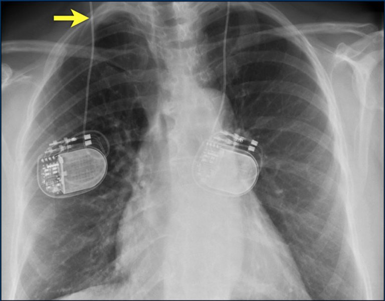 The Radiology Assistant : Cardiovascular devices