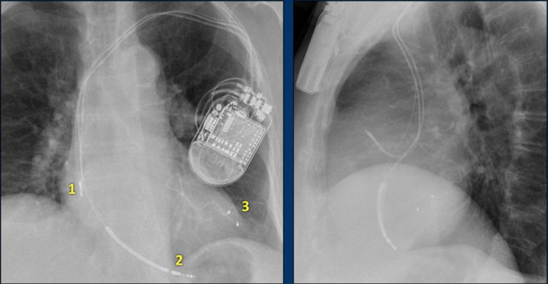 The Radiology Assistant : Cardiovascular devices