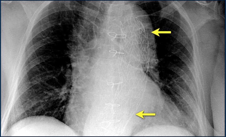 The Radiology Assistant : Cardiovascular devices