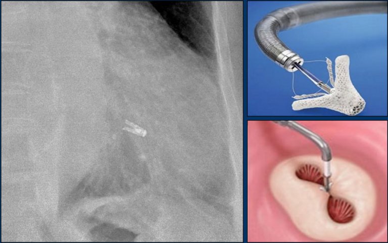 The Radiology Assistant : Cardiovascular devices