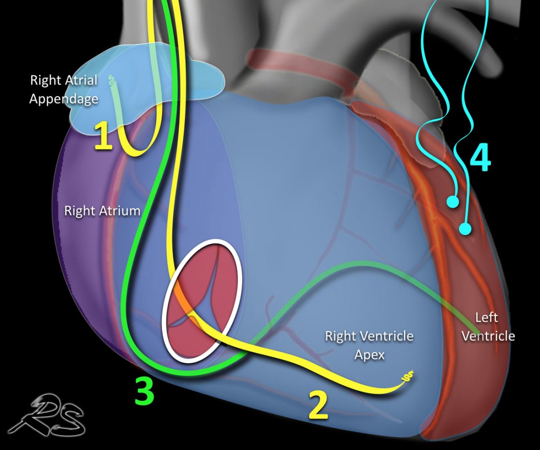 The Radiology Assistant : Cardiovascular devices