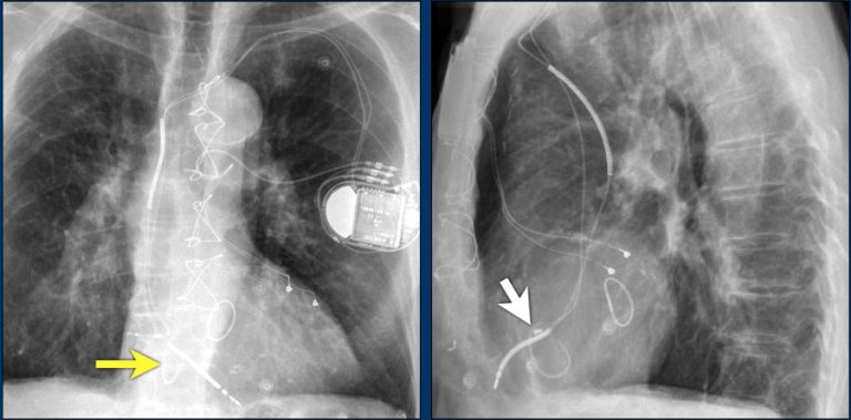 The Radiology Assistant : Cardiovascular devices