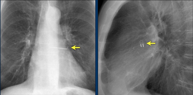 The Radiology Assistant : Cardiovascular devices
