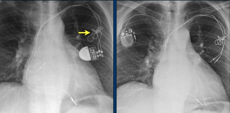 The Radiology Assistant : Cardiovascular devices