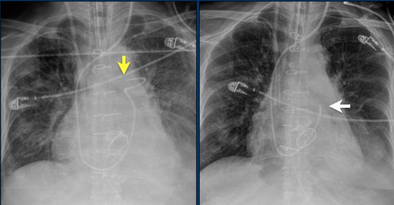 The Radiology Assistant : Cardiovascular devices