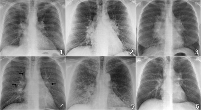 The Radiology Assistant : Chest X-Ray - Basic Interpretation