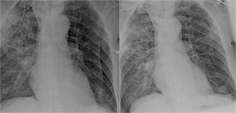 The Radiology Assistant : Chest X-Ray - Basic Interpretation