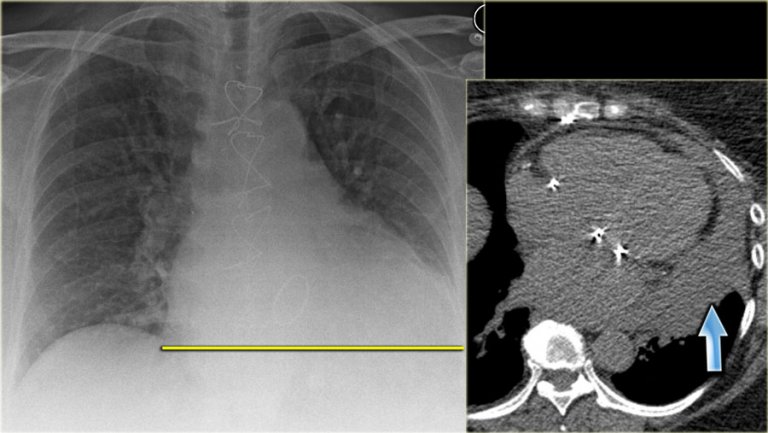 The Radiology Assistant : Chest X-Ray - Heart Failure