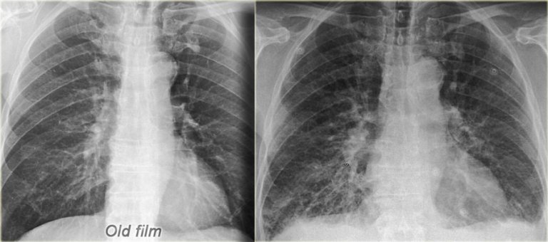 The Radiology Assistant : Chest X-Ray - Lung disease