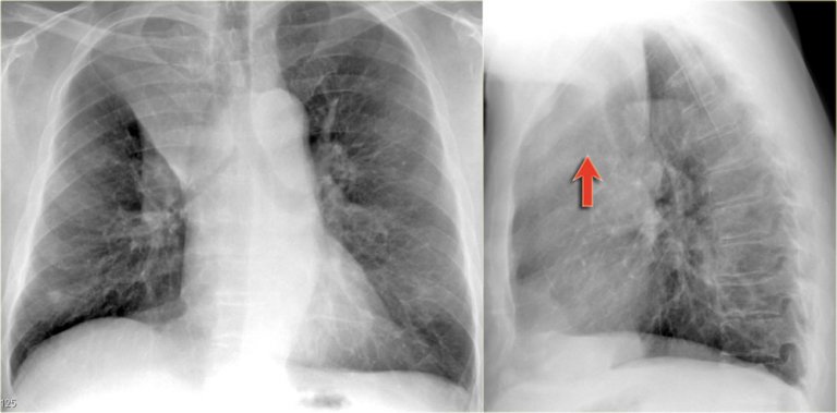 The Radiology Assistant : Chest X-Ray - Lung disease